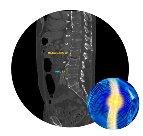 Osteoporosis Detection Nanox Ai
