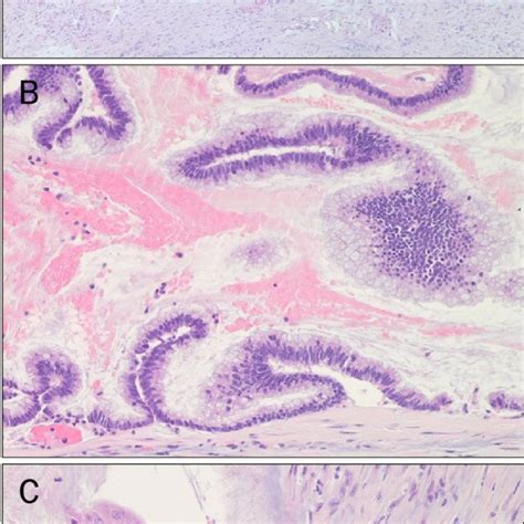 Colonoscopic Findings Of The Orifice Of Appendix A Colonoscopy Download Scientific Diagram