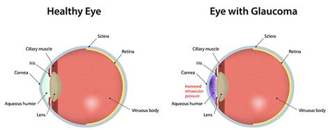 Glaucoma Thousand Oaks Glaucoma Treatment Simi Valley