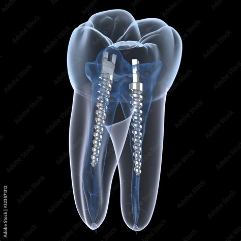 Dental Steel Post Inside Molar Teeth Xray View Dental Endodontic