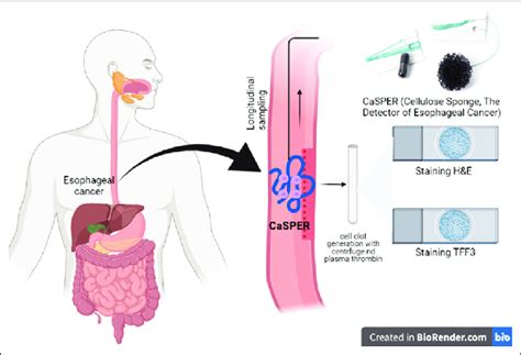 Casper Cellulose Sponge The Detector Of Esophageal Cancer Download