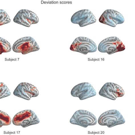 Deviation Score Maps For Theta Band Power In Four Patients The Color Download Scientific