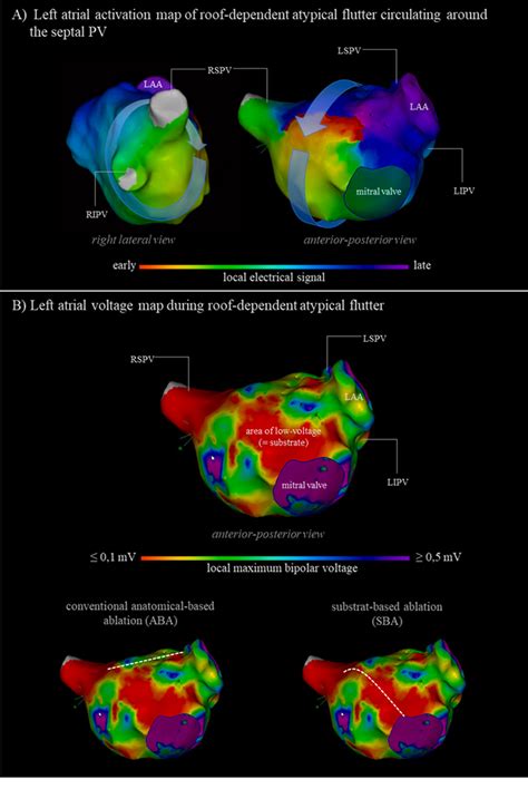 Figure 1 From Substrate Based Ablation Of Atypical Atrial Flutter In