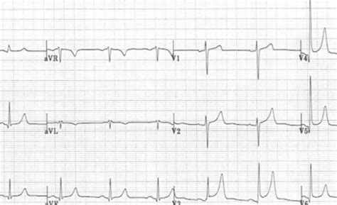 Ekg Ischemia And Infarction Flashcards Quizlet