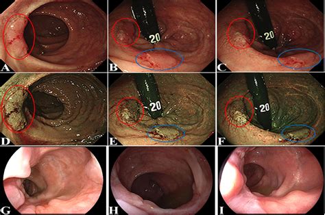 Sigmoid Colon Cancer Staging Colon And Sigmoid Cancer By Ct And Mri