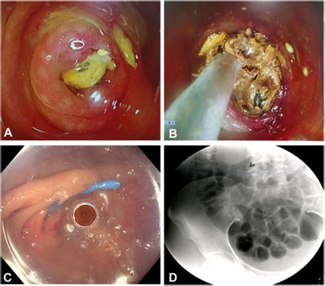 Top Tips For Endoscopic Retrograde Appendicitis Therapy With Video