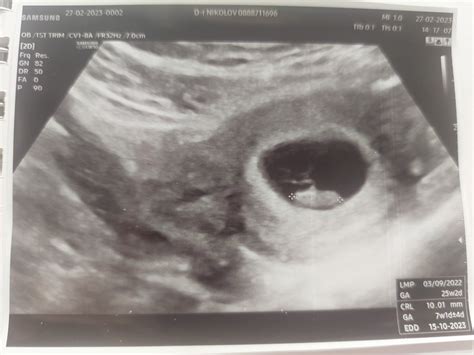 Разчитане на снимка от ехограф Бъдещи майки Страница 10 Мнения от Bg Mamma