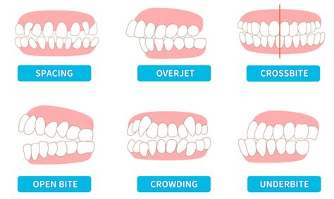 Malocclusion Types And Treatments Invisible Braces