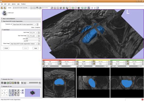 Projectsprostatesegmentation Namic Wiki
