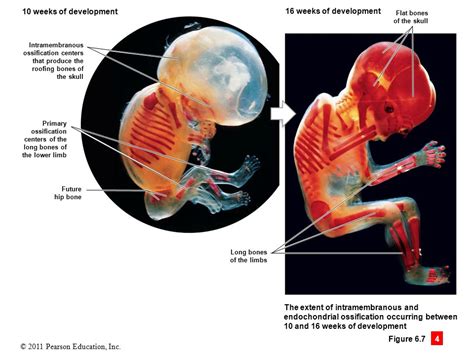 Intramembranous Ossification Fetal Skull Newborns Cranial Vault