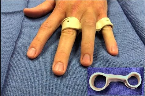 Extensor Tendon Injuries Hand Orthobullets