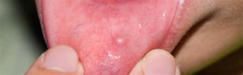 Benjolan Di Bibir Tapi Tidak Sakit Apa Penyebabnya Klinik Gigi SATU Dental