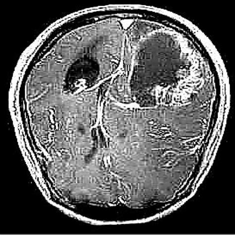 Tumor Classification Object Detection Dataset V3 2023 03 31 11 37pm By Sri Venkateswara