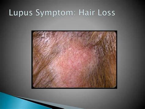 Ppt Systemic Lupus Erythematous And Scleroderma Crest Syndrome