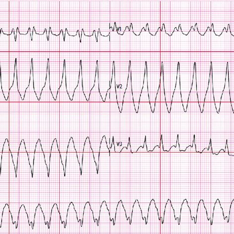 Ecg Showing Ventricular Tachycardia Ecg Electrocardiogram Download