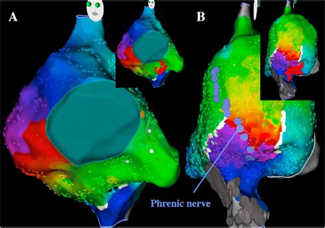 Main Atrial Flutter Circuits In Patients With Tetralogy Of Fallot A Download Scientific