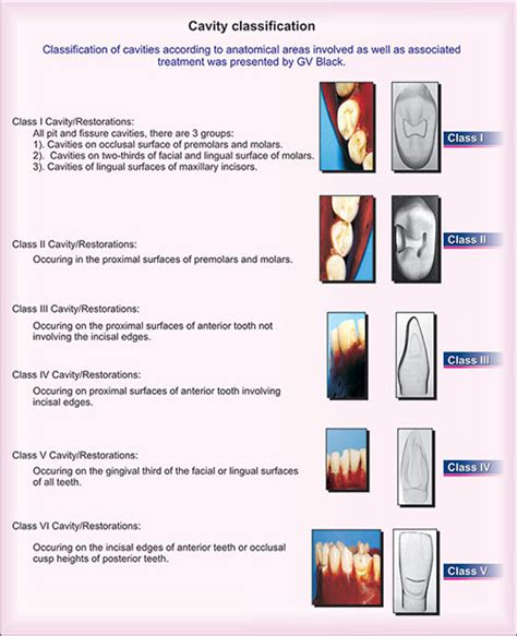 Gv Black Classification Of Caries Medizzy 57 Off