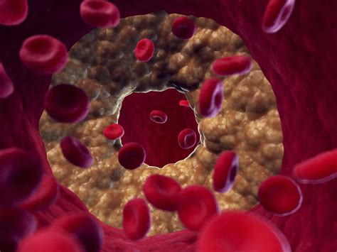 Clogged Arteries Symptoms Treatment And Prevention
