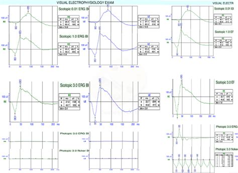 Full Field Electroretinogram Full Field Erg Shows Severe Reduced Download Scientific Diagram