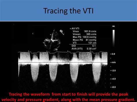 Normal Aortic Valve Echo Macrophages Promote Aortic Valve Cell Calcification And Alter Stat3