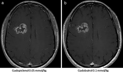 Mri Contrast Alternative To Gadolinium