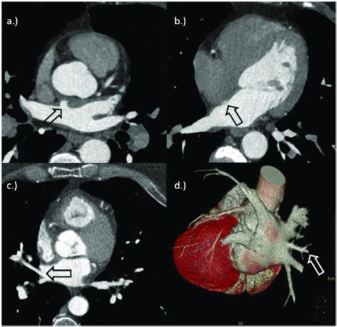 A Cardiac Ct Of A 55 Years Old Female Patient With Af The Arrow Download Scientific Diagram