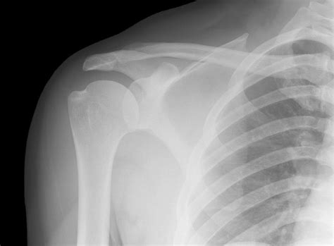 Xray Shoulder Normal