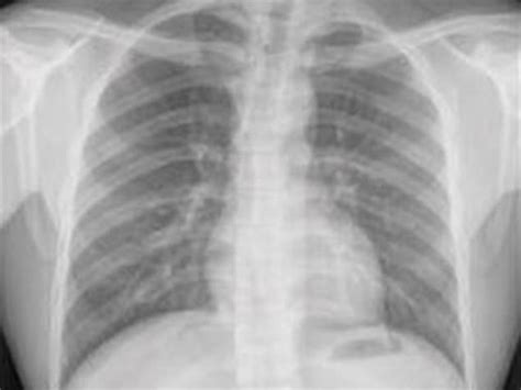 Ai Model Determines Cardiovascular Risk From Routine Chest X Ray