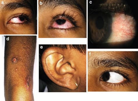 Lichen Scrofulosorum And Phlyctenular Conjunctivitis The National Medical Journal Of India