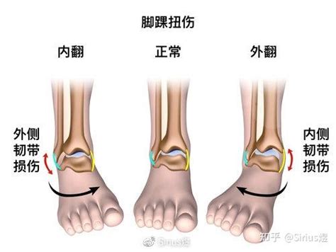 预防习惯性脚踝扭伤和慢性脚踝不稳，你该做的最重要的事情是什么？ 知乎