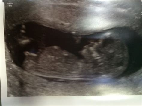 Turtle Sign Ultrasound