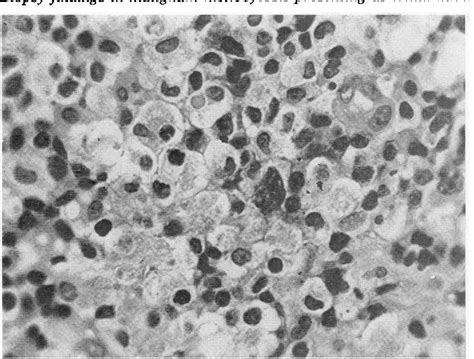Figure 6 From 600 Histological Findings Of Biopsy Material From Nasal Lesions In 19 Cases Aozasa