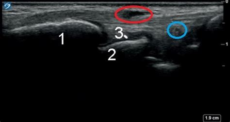 Dorsal Wrist Scaphoid And Radius Image Sonosite Institute For Point Of Care Ultrasound