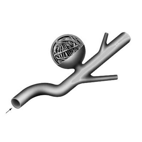 13 Coiled Aneurysm Scheme Neurochirurgie 1090 Wien Facharztzentrum