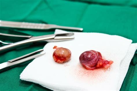 Epididimitis Gejala Penyebab Komplikasi Cara Mengobati