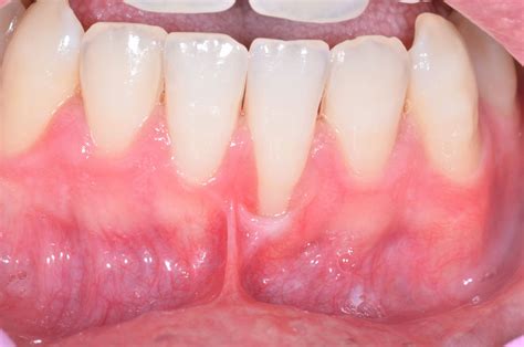 Gallery Root Coverage Recession Uptown Guelph Dental