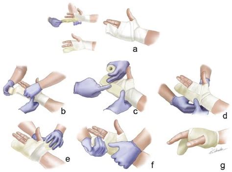 Ulnar Gutter Splint Cast Short Arm Splinting Technique General Steps