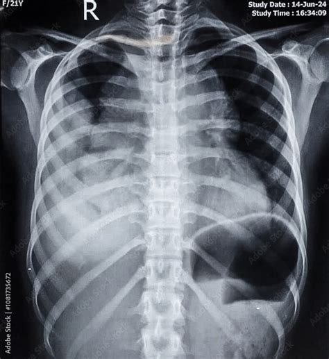 Chest Xray Showing Rt Sided Lamellar Pleural Effusion Mediastinal