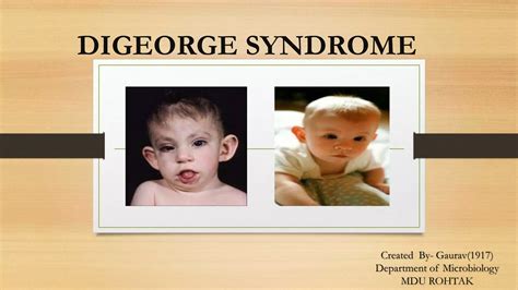 Digeorge Syndrome Pptx