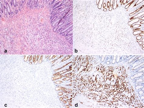A Poorly Differentiated Carcinoma Involving Colonic Submucosa He Download Scientific Diagram
