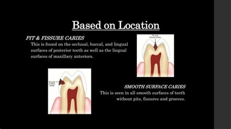 Dental Caries Classification And Microbiology Pptx