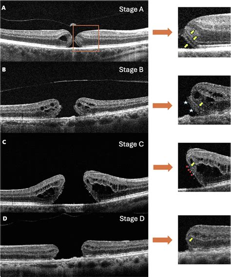 Macular Hole Staging System May Aid Surgical Planning Predict Outcomes