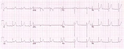 12 Lead Mimics 4 8 Flashcards Quizlet