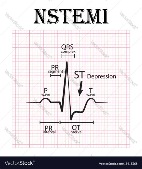 Ecg Non St Elevation Myocardial Infarction Vector Image The Best Porn