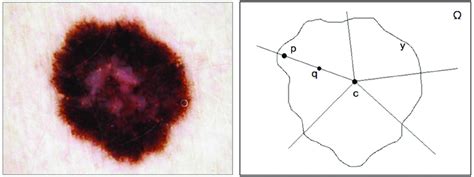 The Original Image And Segmentation Label Of Melanoma Image Full Size Download Scientific