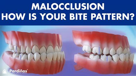 Malocclusion