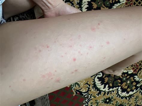 Ожог после лазерной эпиляции бикини фото