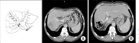 Figure 1 From Parenchymal Sparing Anatomical Hepatectomy Based On Portal Ramification Of The