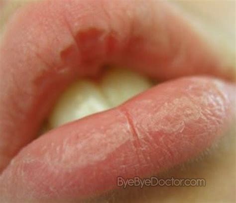 Chapped Lips Causes Symptoms Causes Treatment And Prevention Of Diseases