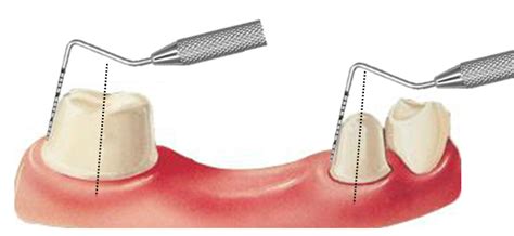 Checking For Parallelism International Dentist Central